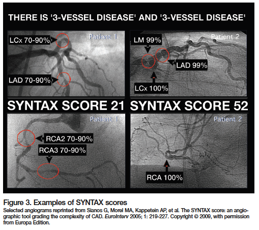What is the SYNTAX Score and How Should We Use It?